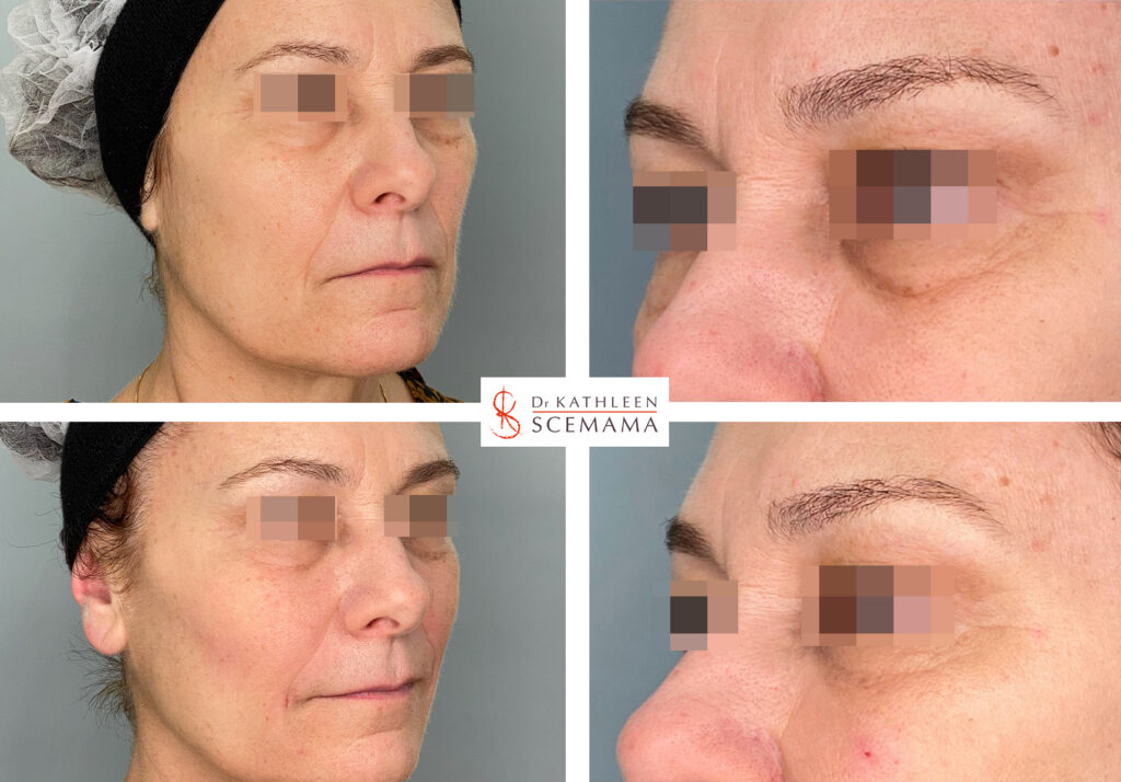 Traitement des cernes : injection acide hyaluronique | Paris | Dr Scemama