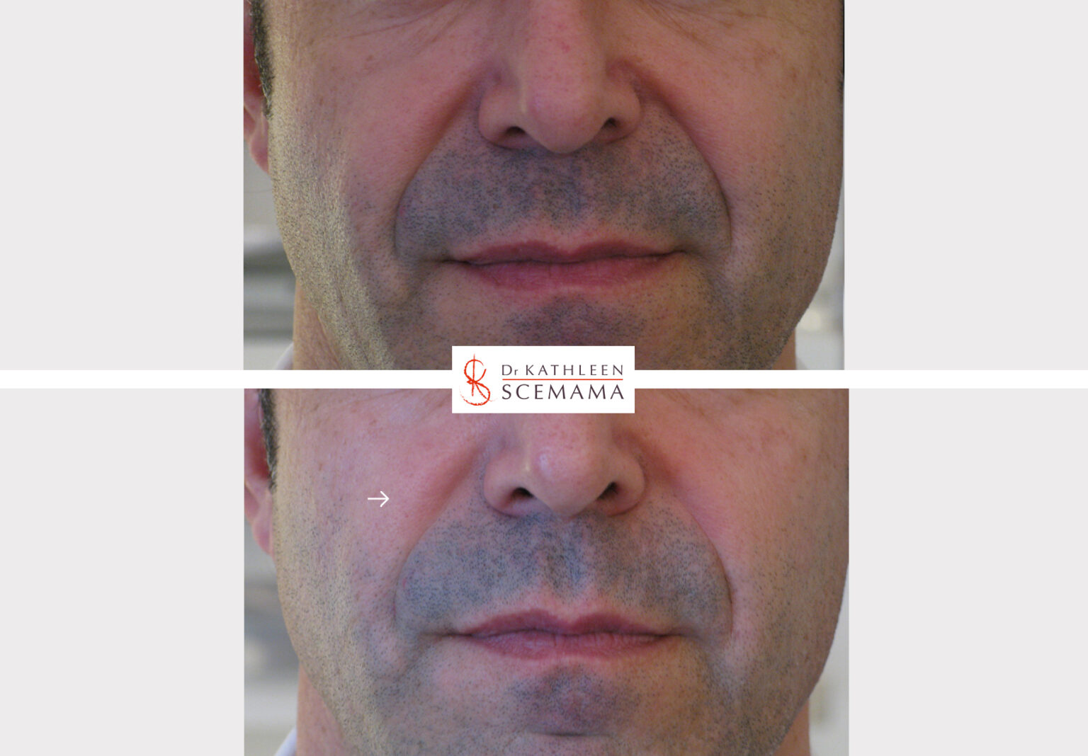 Sillons nasogéniens : injections acide hyaluronique | Paris | Dr Scemama