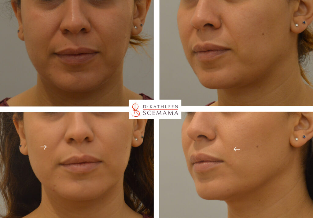 Sillons nasogéniens : injections acide hyaluronique | Paris | Dr Scemama