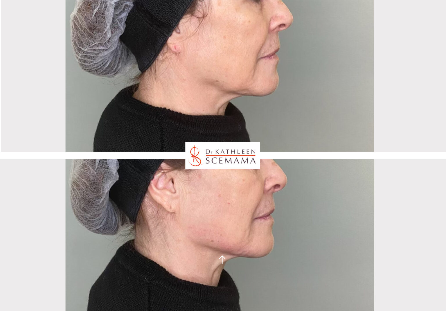 Jawline : injections d'acide hyaluronique | Paris | Dr Kathleen Scemama