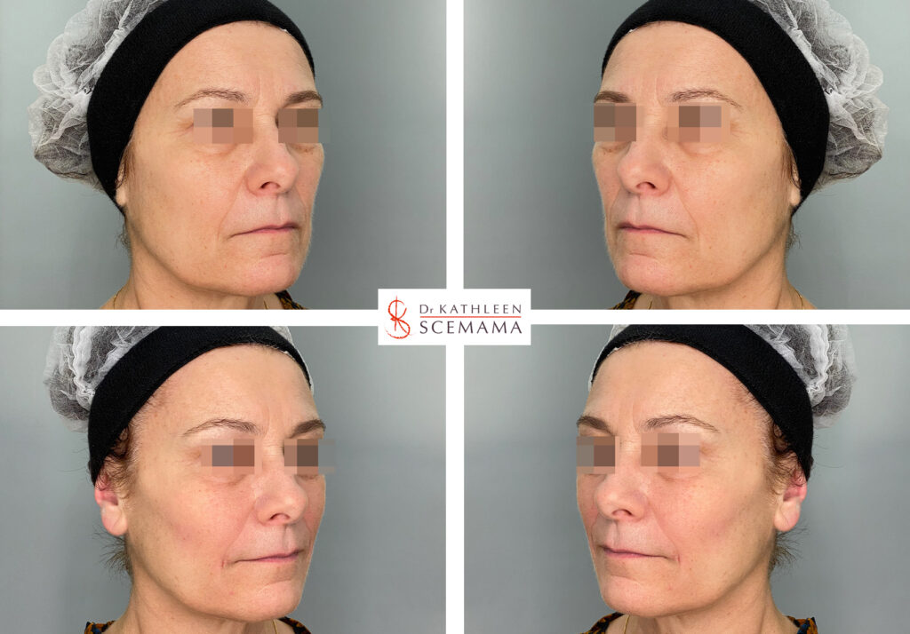 Traitement des pommettes : acide hyaluronique | Paris | Dr Scemama