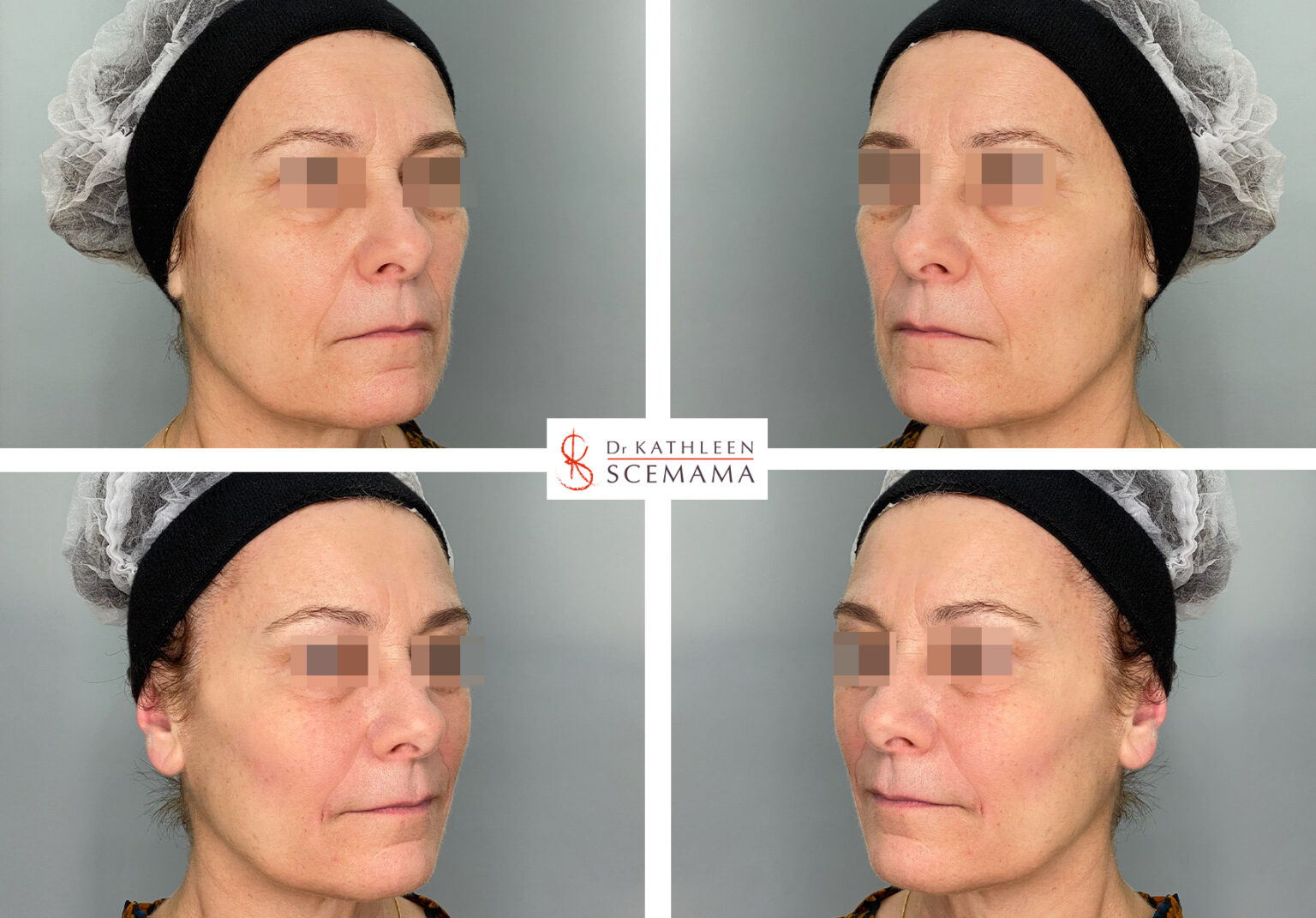 Traitement des pommettes : acide hyaluronique | Paris | Dr Scemama