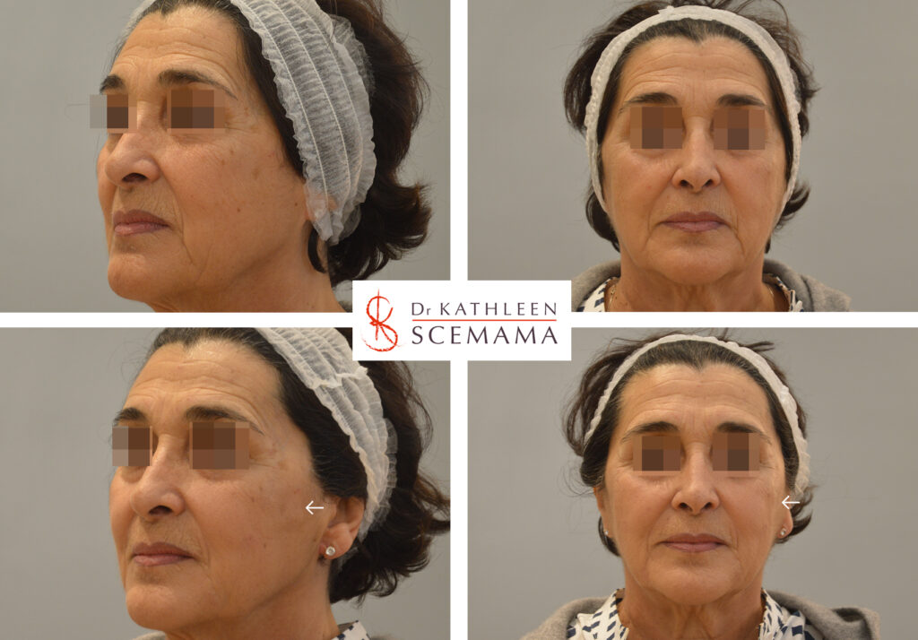 Traitement des pommettes : acide hyaluronique | Paris | Dr Scemama