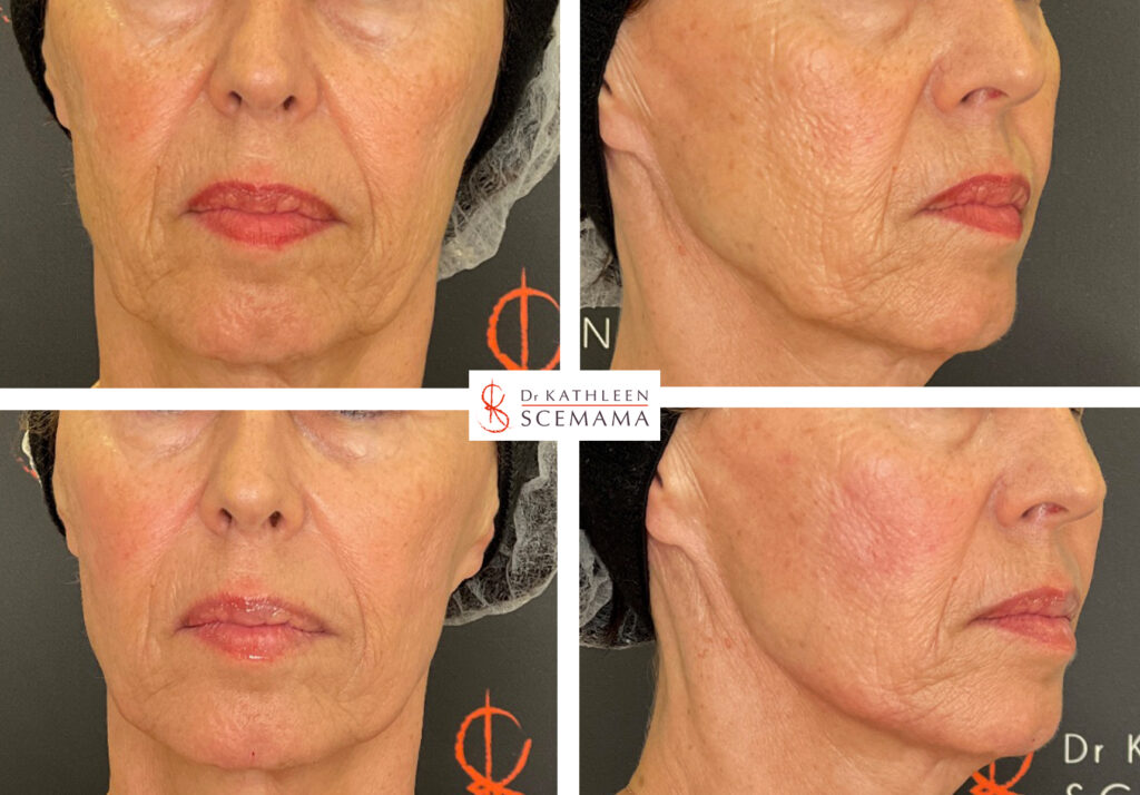 Injection acide hyaluronique | Prix | Médecine esthétique | Paris | Dr ...